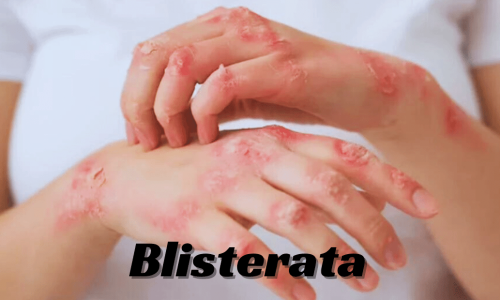 Blisterata: Symptoms, Causes, and Treatment